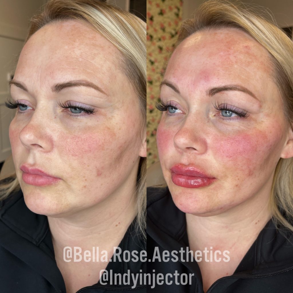 Before and After Treatment Gallery of Bella Rose Aesthetics in Carmel IN